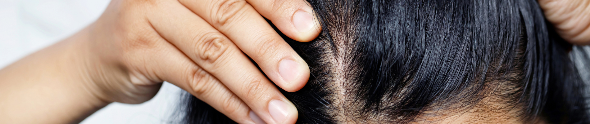 5 Common Hair Concerns and How to Treat Them | London Doctors Clinic