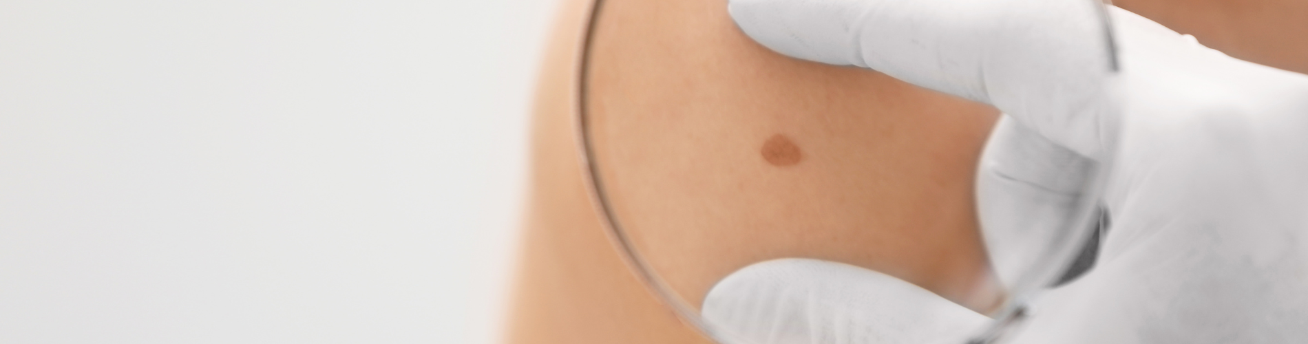 When to get moles checked: A complete guide | London Doctors Clinic